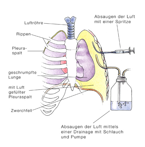 Pneumothorax, Rippenbruch - eesom Gesundheitsportal